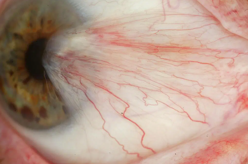 Pterygium – Opthalmic Associates