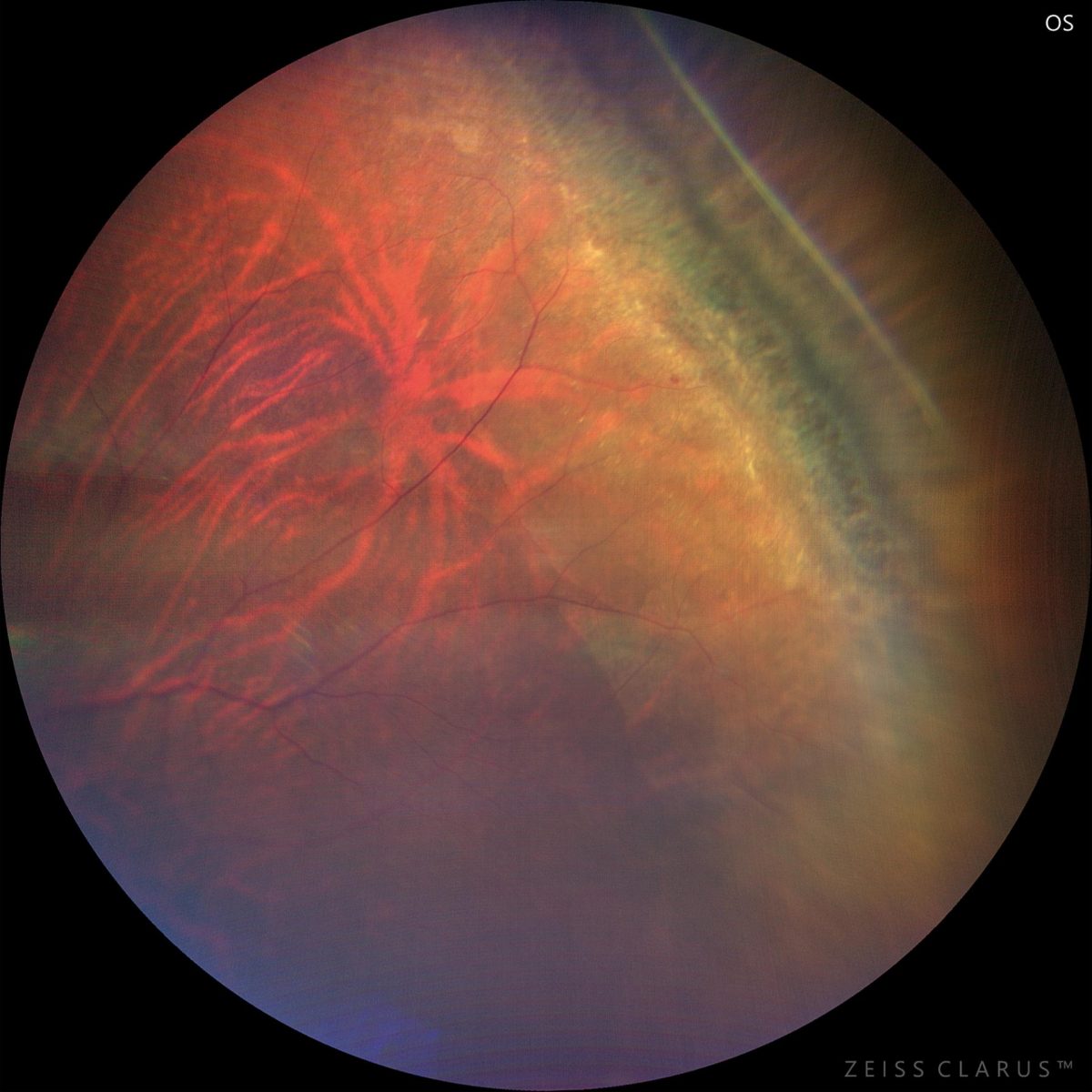 Retinal Detachment – Opthalmic Associates